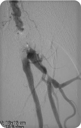 How to manage CFA lesions with an endovascular approach? | Paris ...